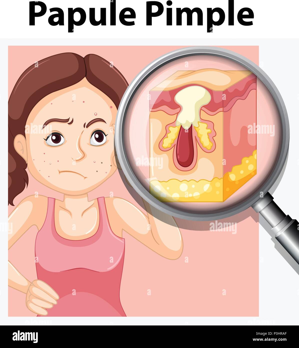 A Papule Pimple on Teenager Face illustration Stock Vector Image & Art ...