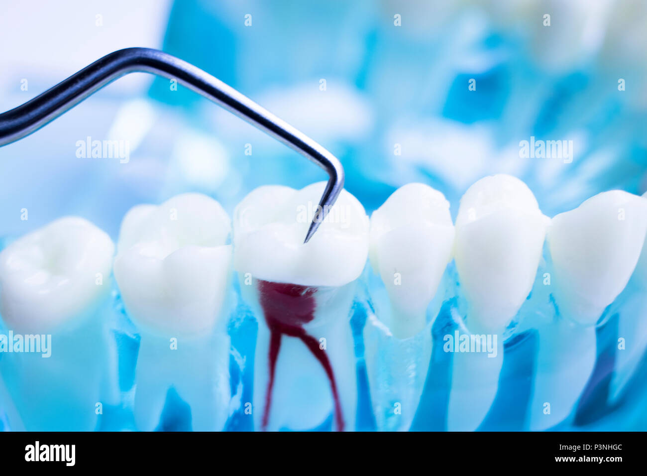 Dentist cleaning teeth with titanium metal tooth pick instrument to ...