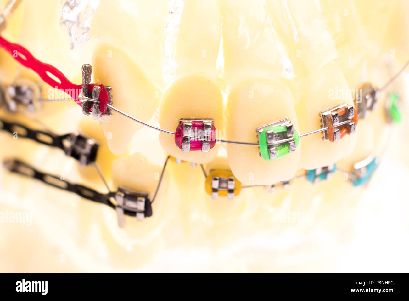 Dental metal braces teeth retainer aligners teaching orthodontics model ...