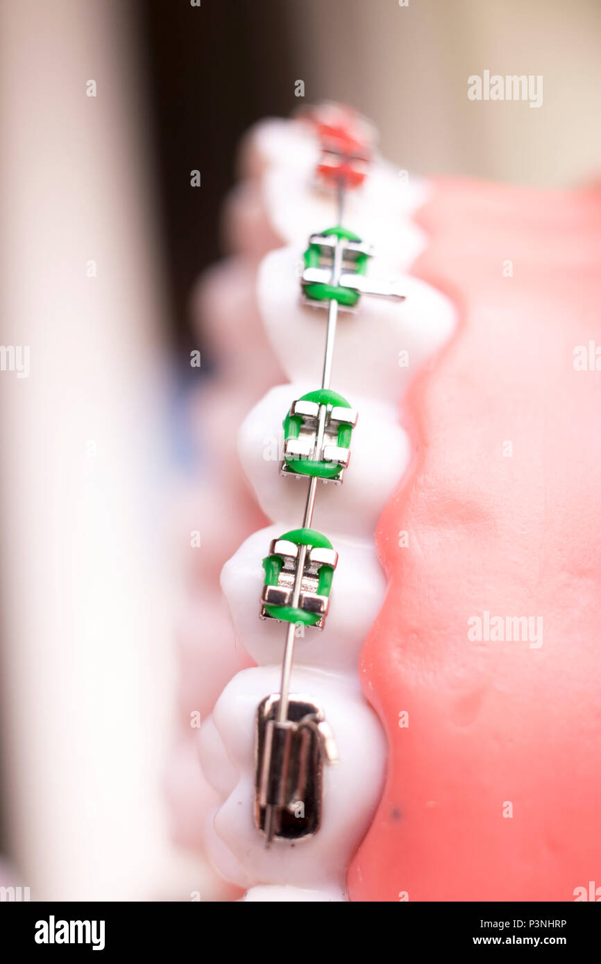 Dental metal braces teeth retainer aligners teaching orthodontics model ...