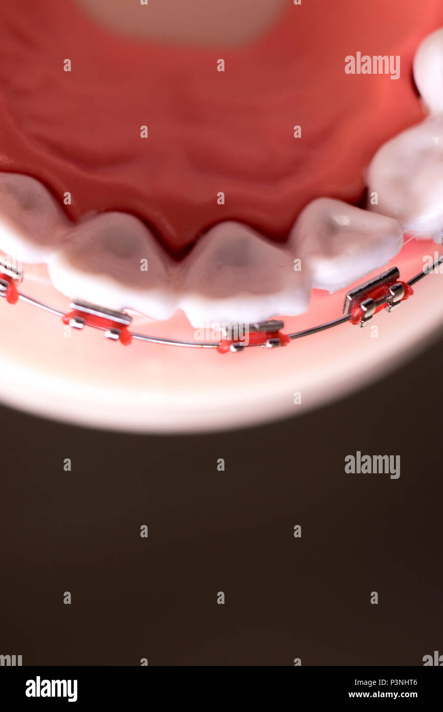 Dental metal braces teeth retainer aligners teaching orthodontics model ...