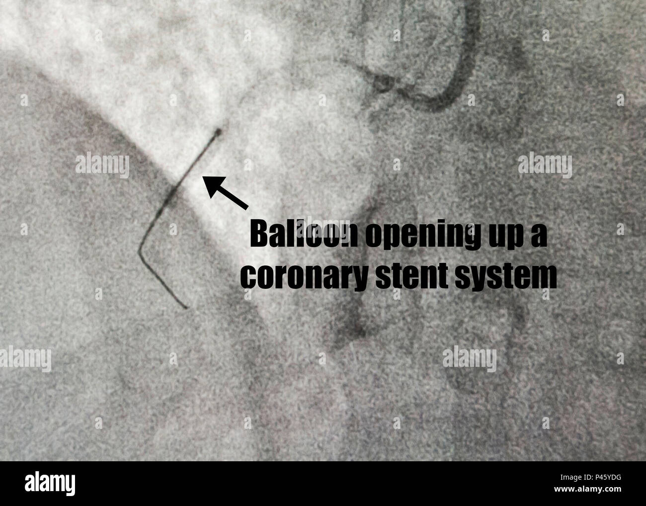 Coronary catheterization hi-res stock photography and images - Alamy