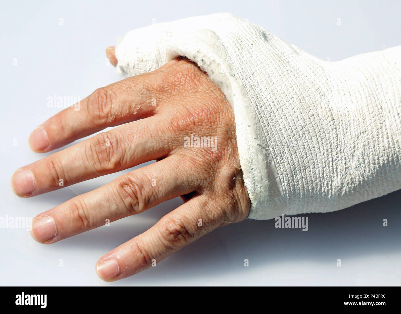 man's hand with fractured bones in the orthopedic hospital emergency ...