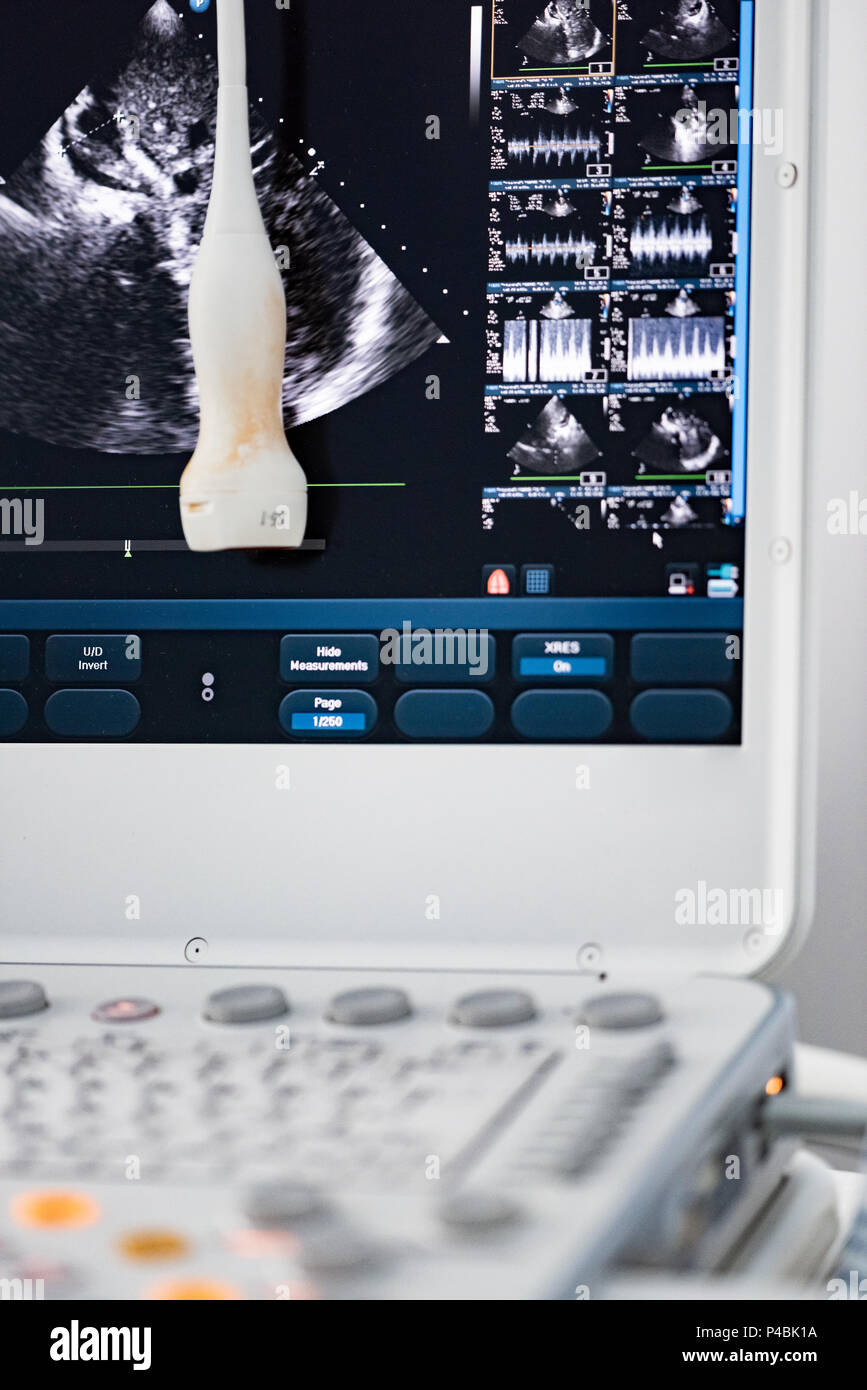 The ultrasound monitor with a picture and a sensor that hangs at the ...