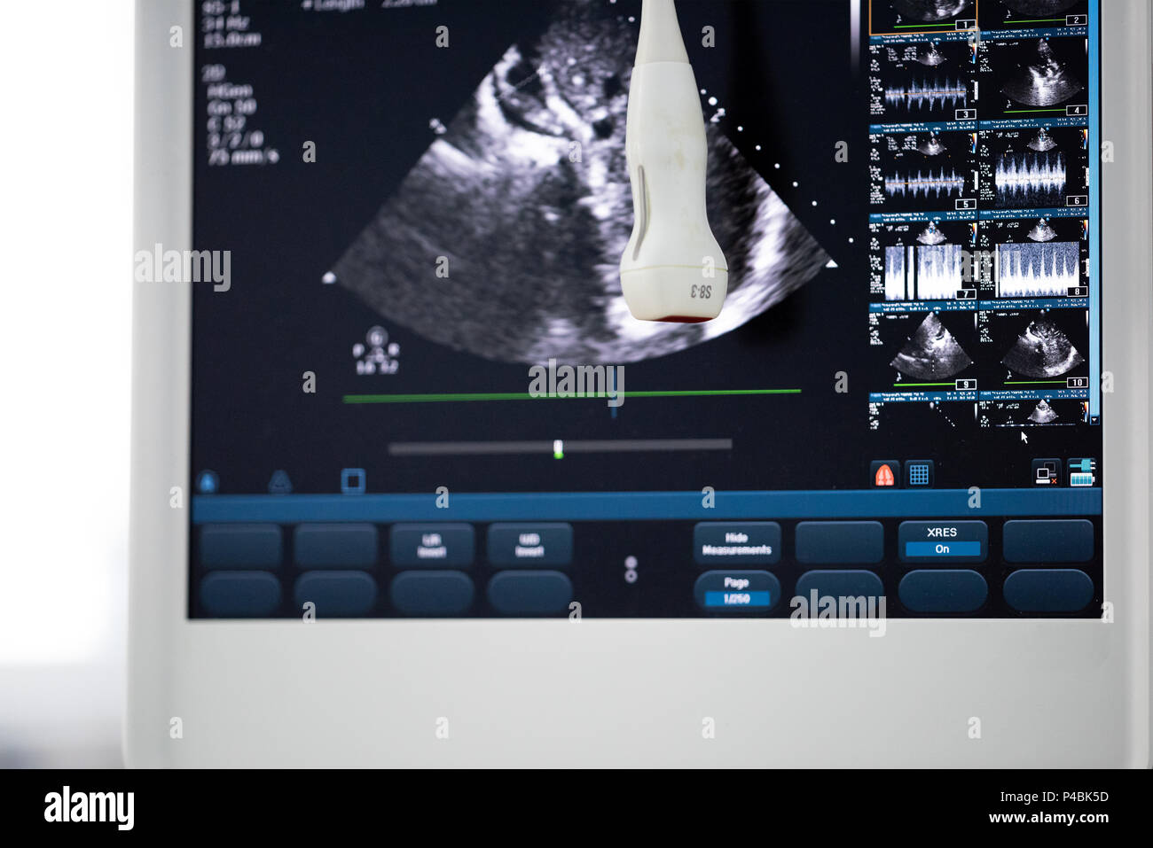 The ultrasound monitor with a picture and a sensor that hangs at the ...