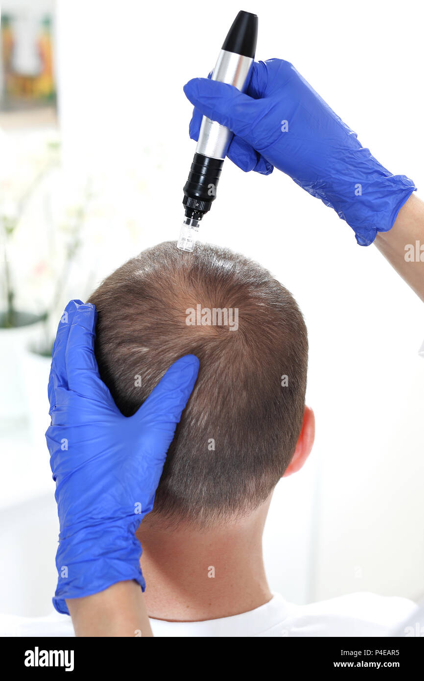 Needle mesotherapy scalp microneedle hi-res stock photography and ...