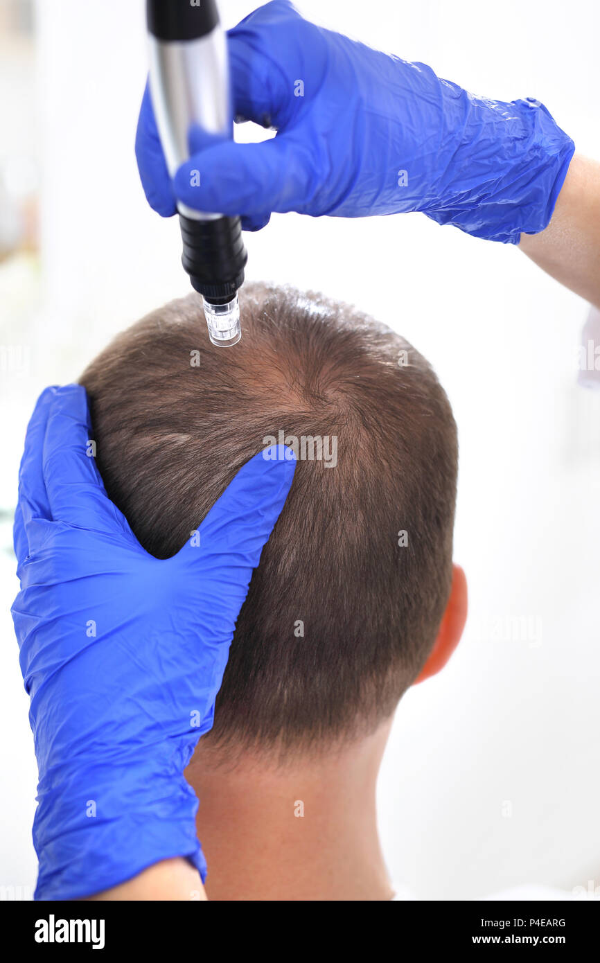 Needle mesotherapy scalp microneedle hi-res stock photography and ...
