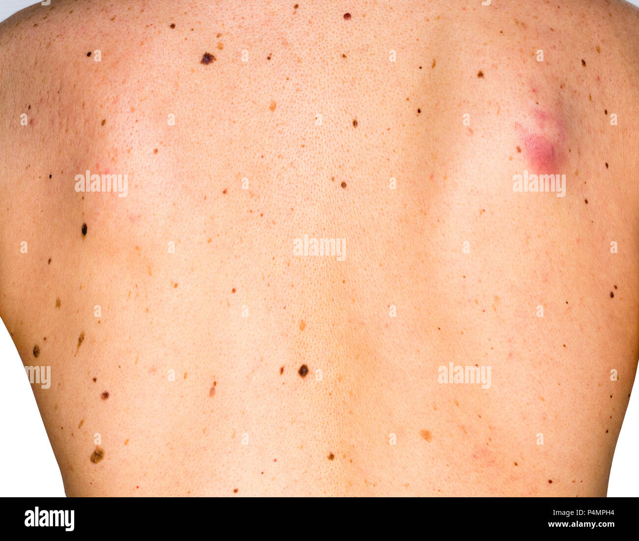 Close up detail of the bare skin on a man back with scattered moles and ...