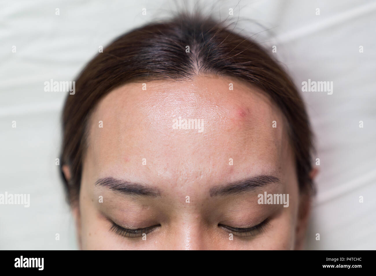 Forehead Scar High Resolution Stock Photography and Images - Alamy