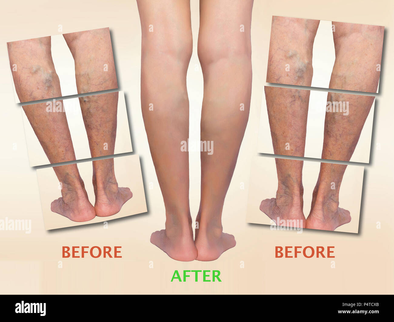 Treatment of varicose before and after. Varicose veins on the legs ...