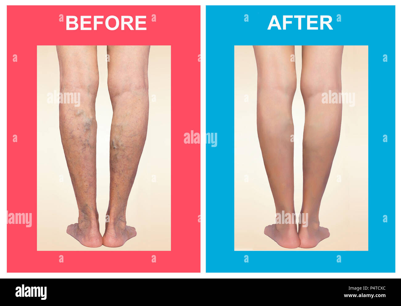 Treatment of varicose before and after. Varicose veins on the legs ...