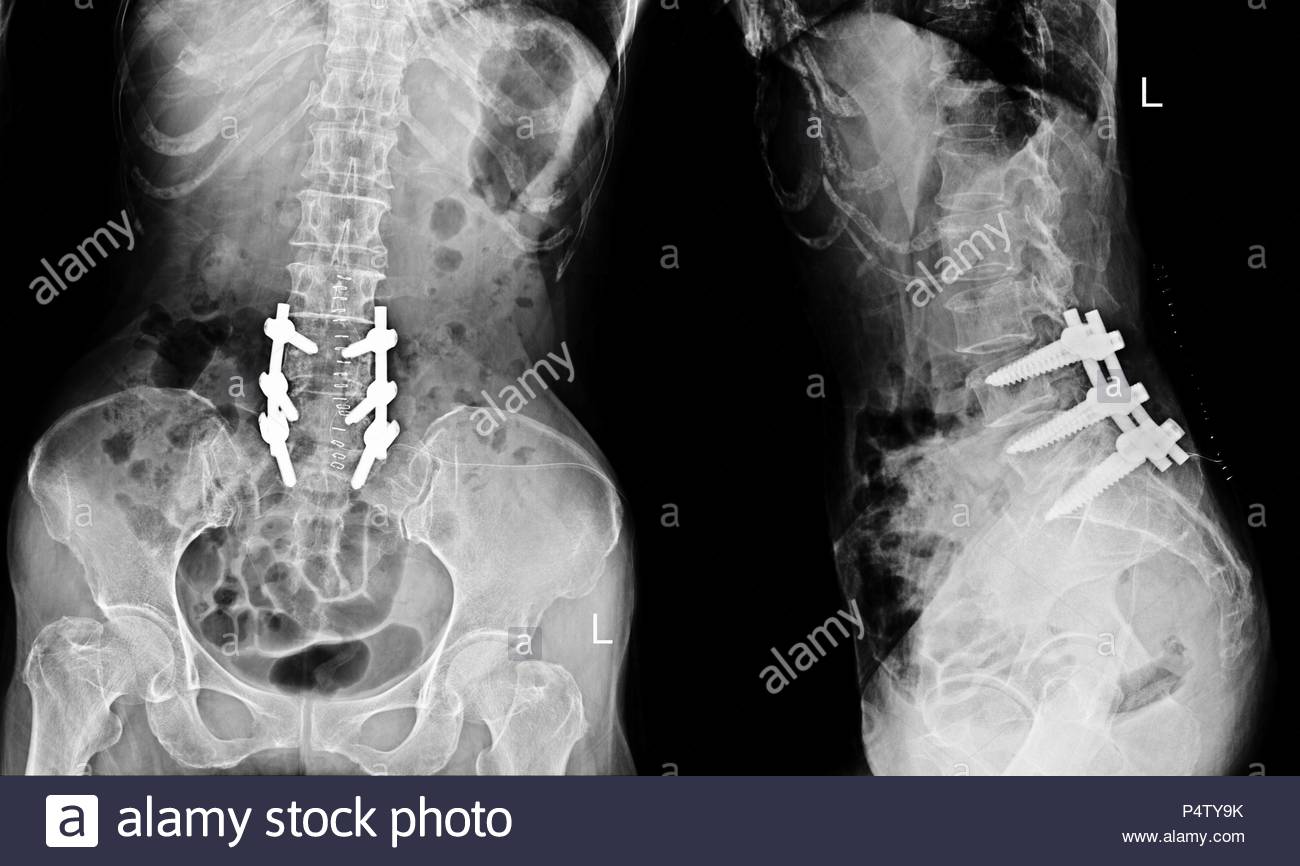 Lumbar Laminectomy Stock Photos & Lumbar Laminectomy Stock Images - Alamy