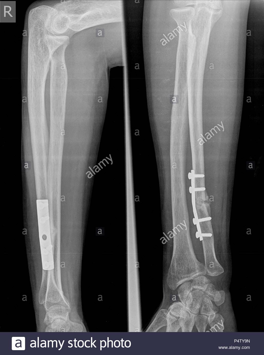 Plate And Screw Stock Photos & Plate And Screw Stock Images - Alamy