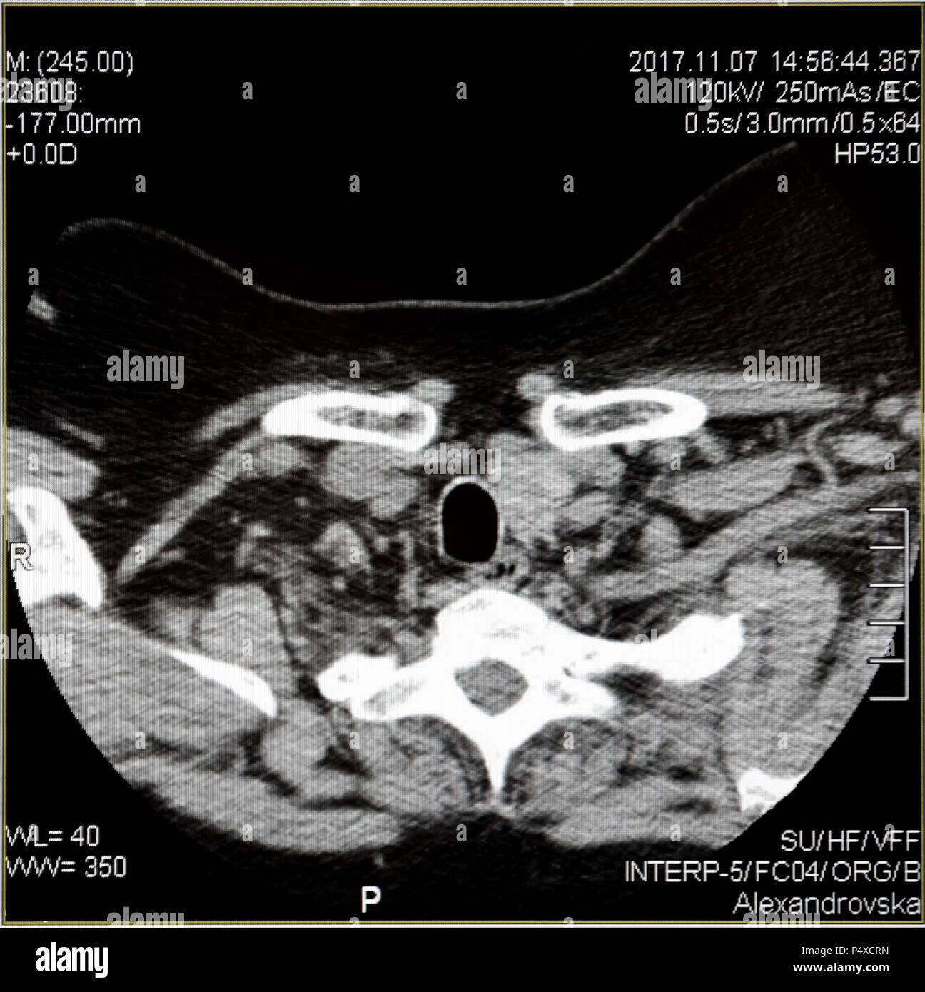 Magnetic resonance imaging (MRI) scan - CT scans of human spine on a ...