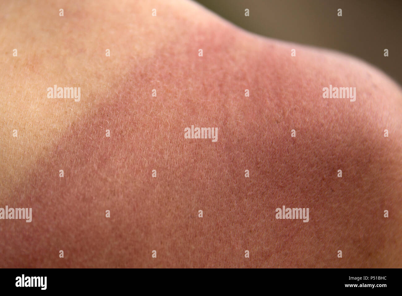 Sunburn unhealthy hi-res stock photography and images - Alamy