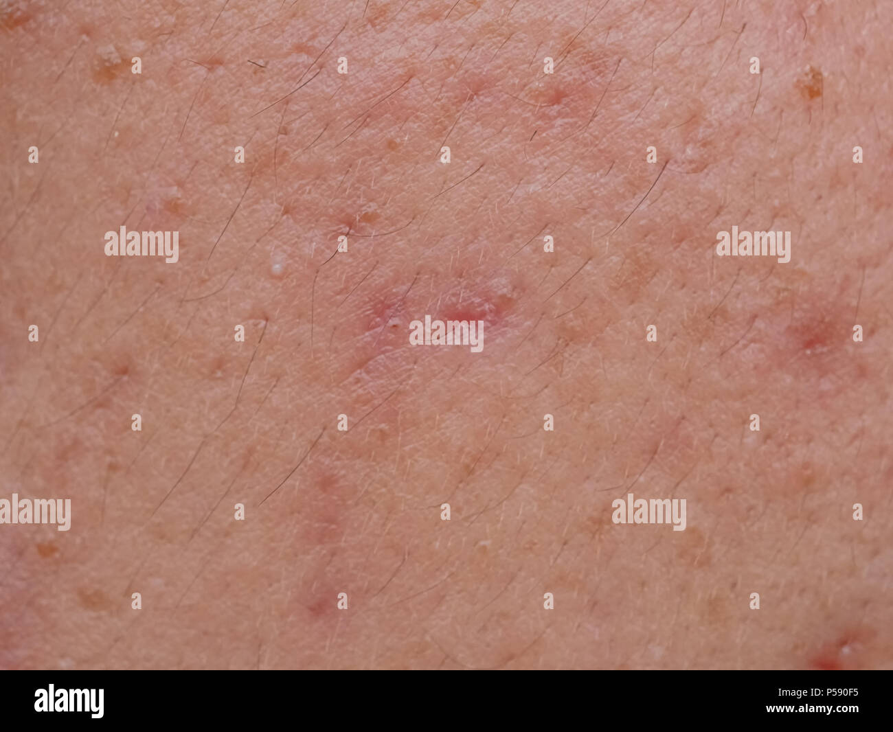 Acne on facial skin,Dermatological disease acne Stock Photo - Alamy