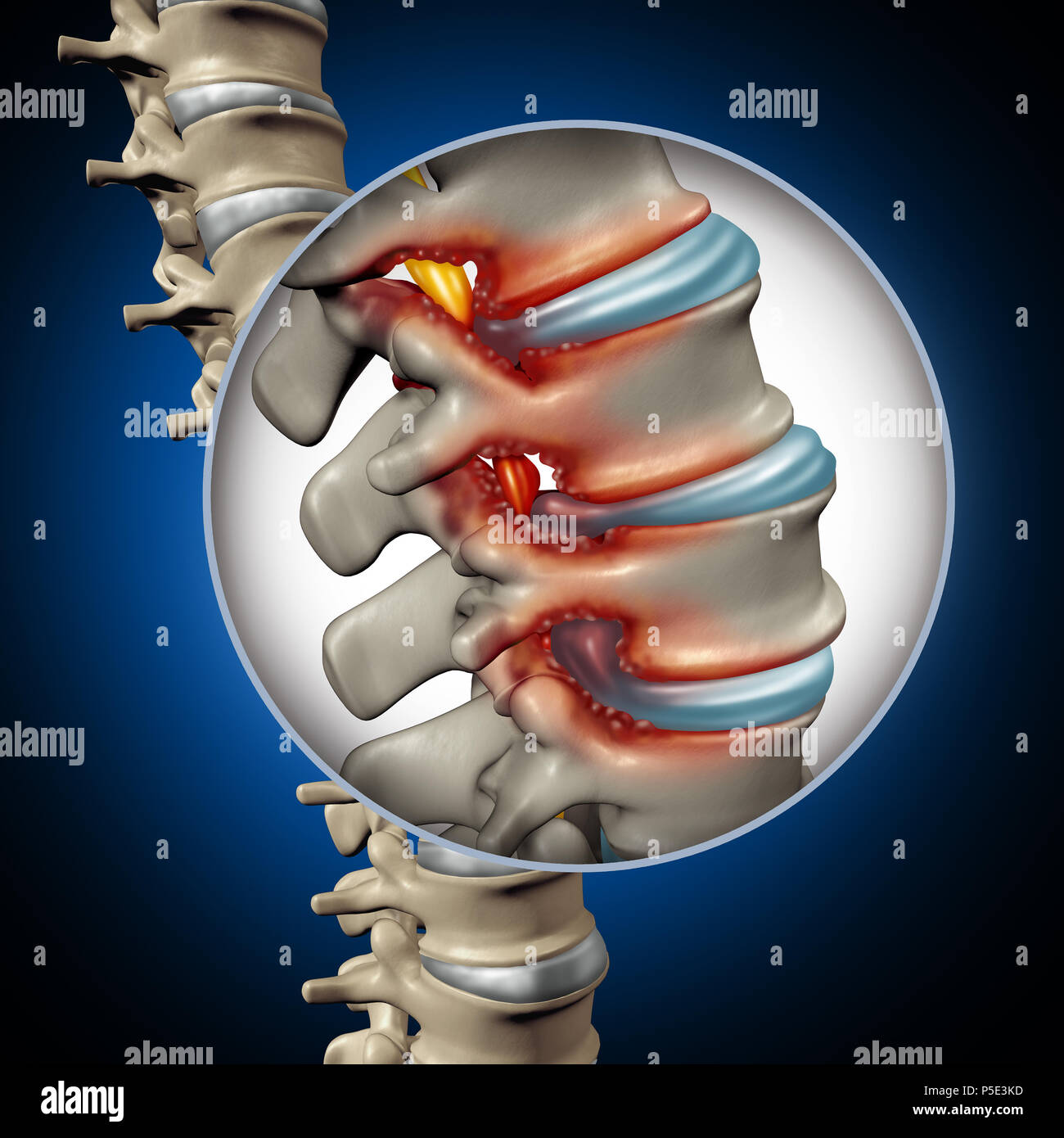 Bone spurs hi-res stock photography and images - Alamy