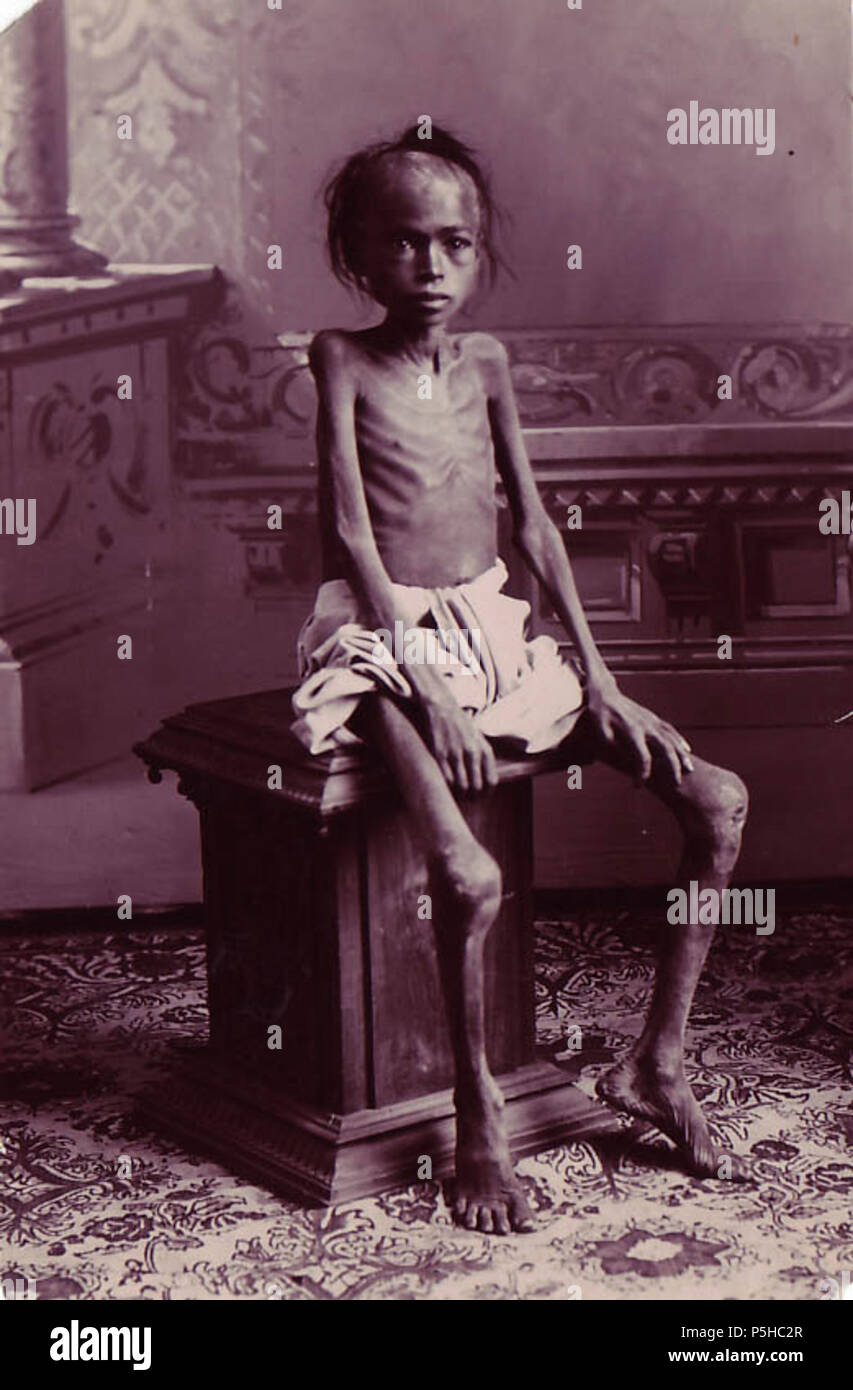 N/A. English: A famine victim boy in India . Unknown date. Unknown 43 A ...