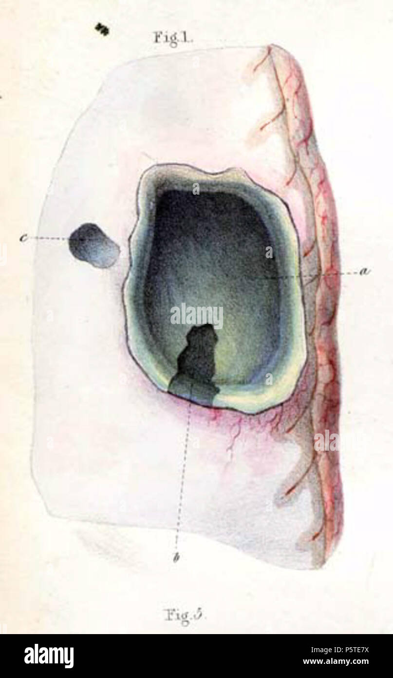 Pathological anatomy hi-res stock photography and images - Alamy