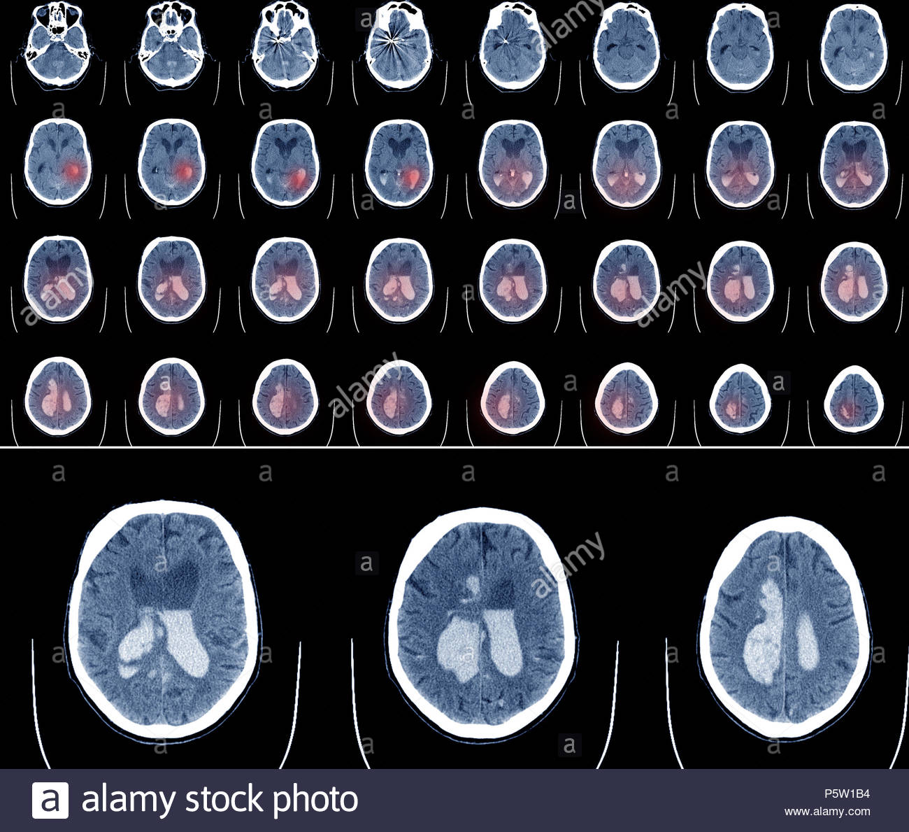 Brain Tumor Scan Stock Photos & Brain Tumor Scan Stock Images - Alamy