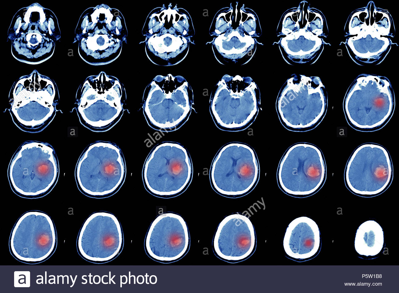 Cerebral Hemorrhage Brain Scan Stock Photos & Cerebral Hemorrhage Brain ...