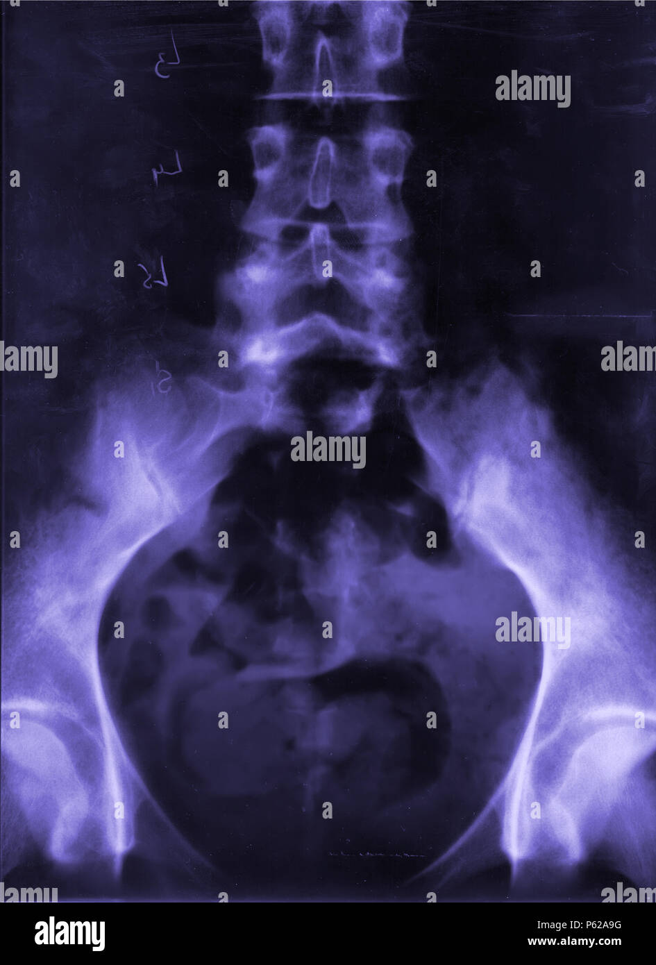 X-Ray image or roentgen of a human body Stock Photo - Alamy
