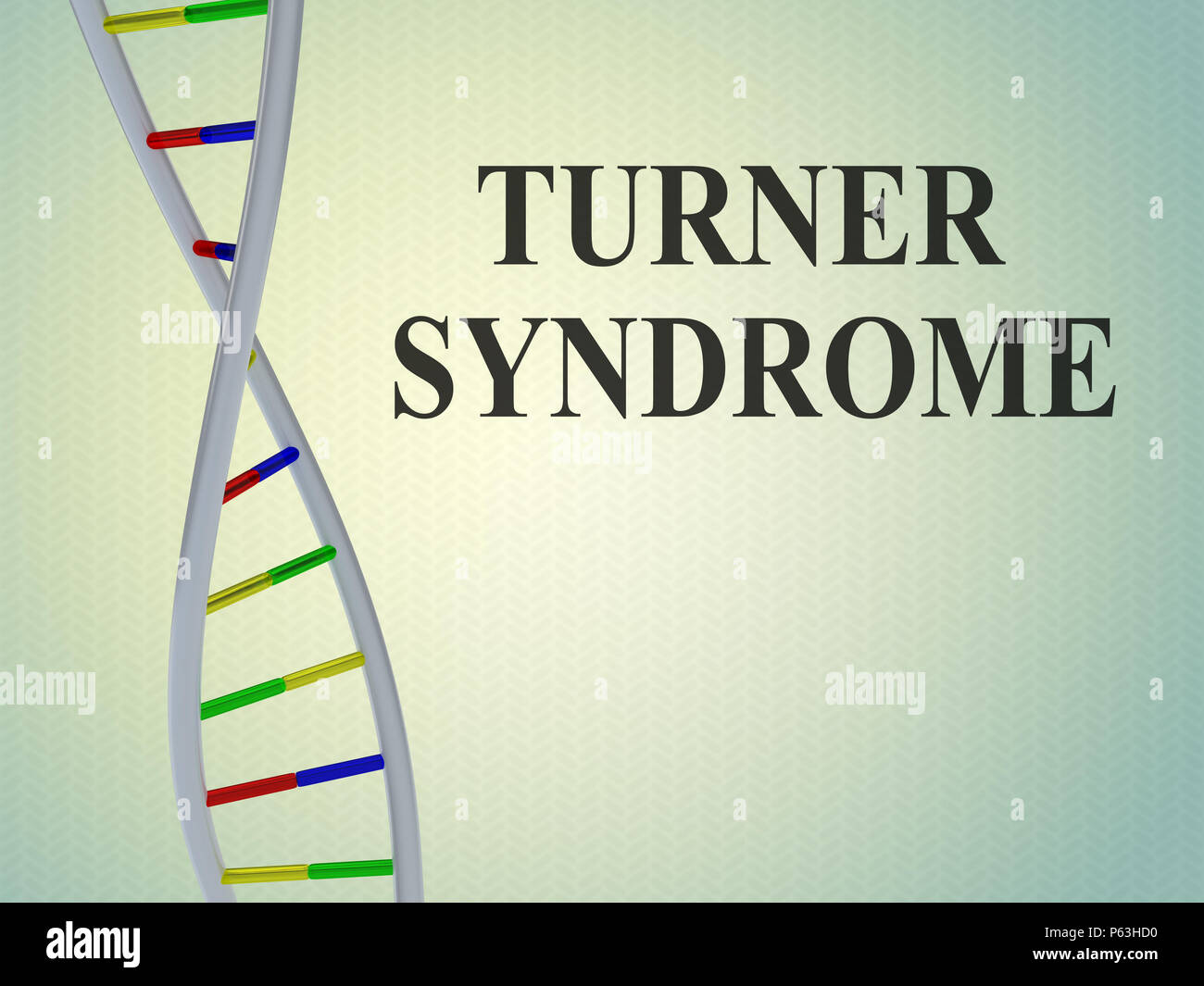 Monosomy Turner Syndrome