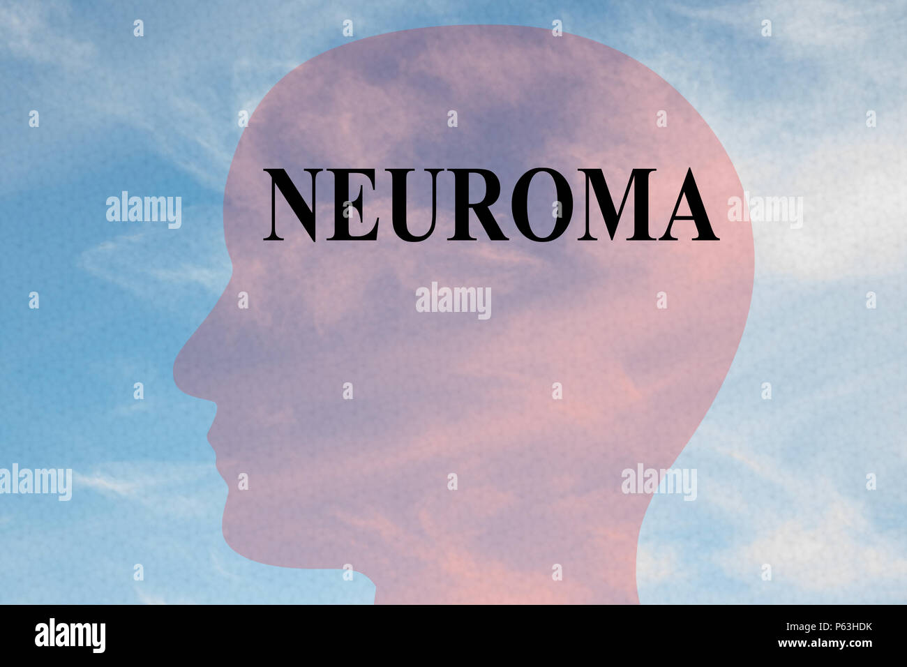 Render illustration of NEUROMA title on head silhouette, with cloudy ...