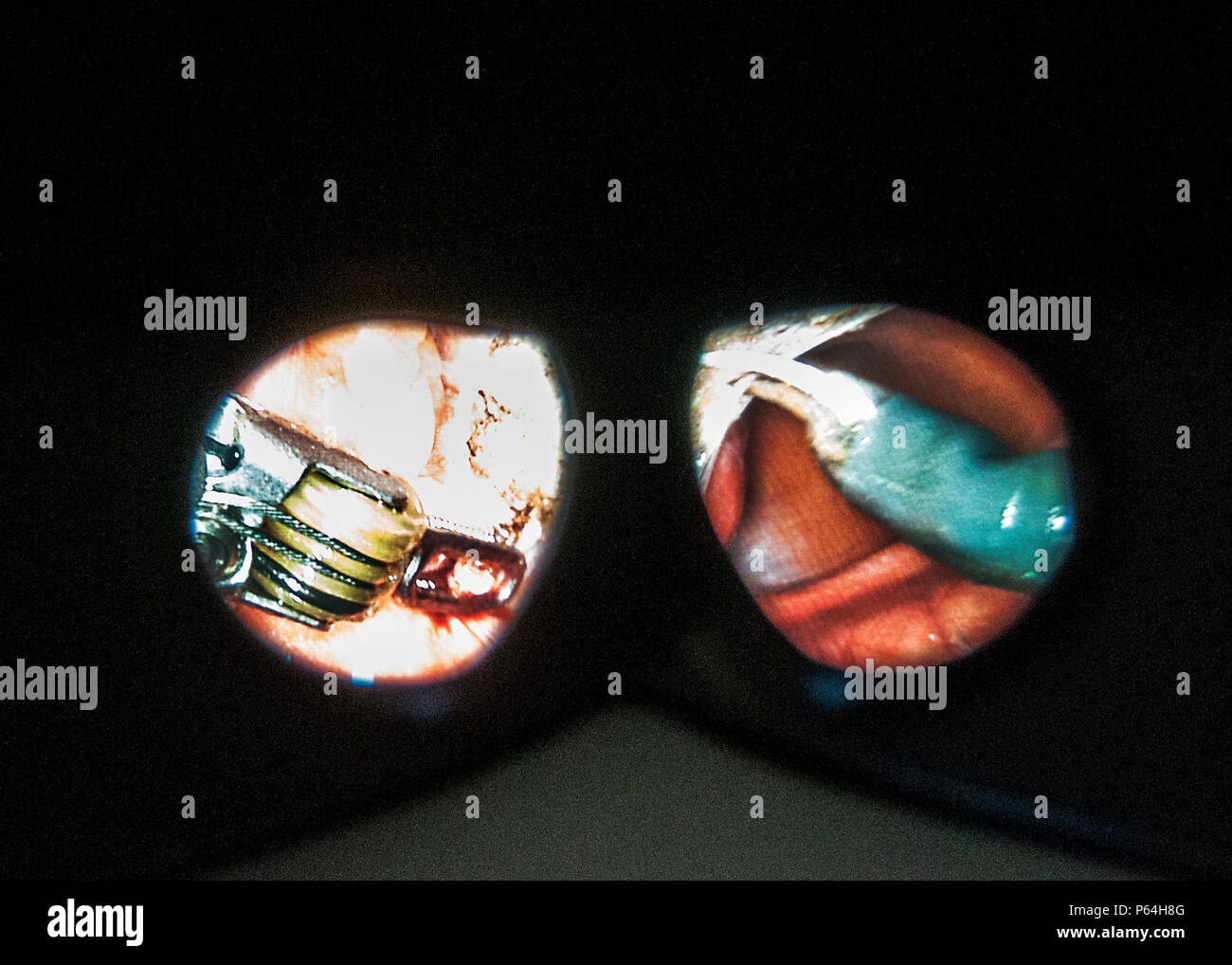 Through a 3D imaging system, the surgeon observes articulating ...