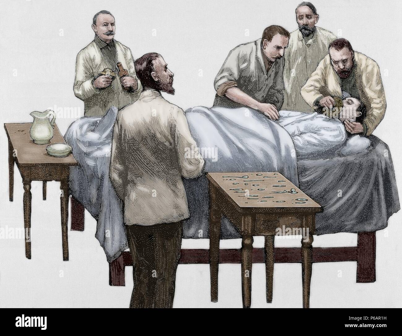 History of medicine. Chloroform anesthesia. Engraving, 19th century ...