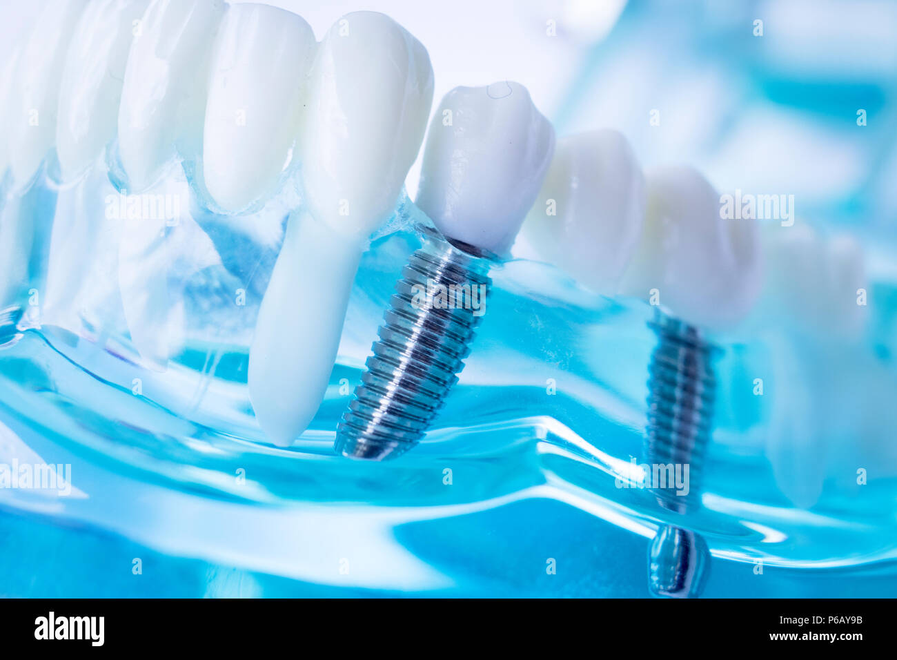 Dentist dental teeth teaching model showing titanium metal tooth ...
