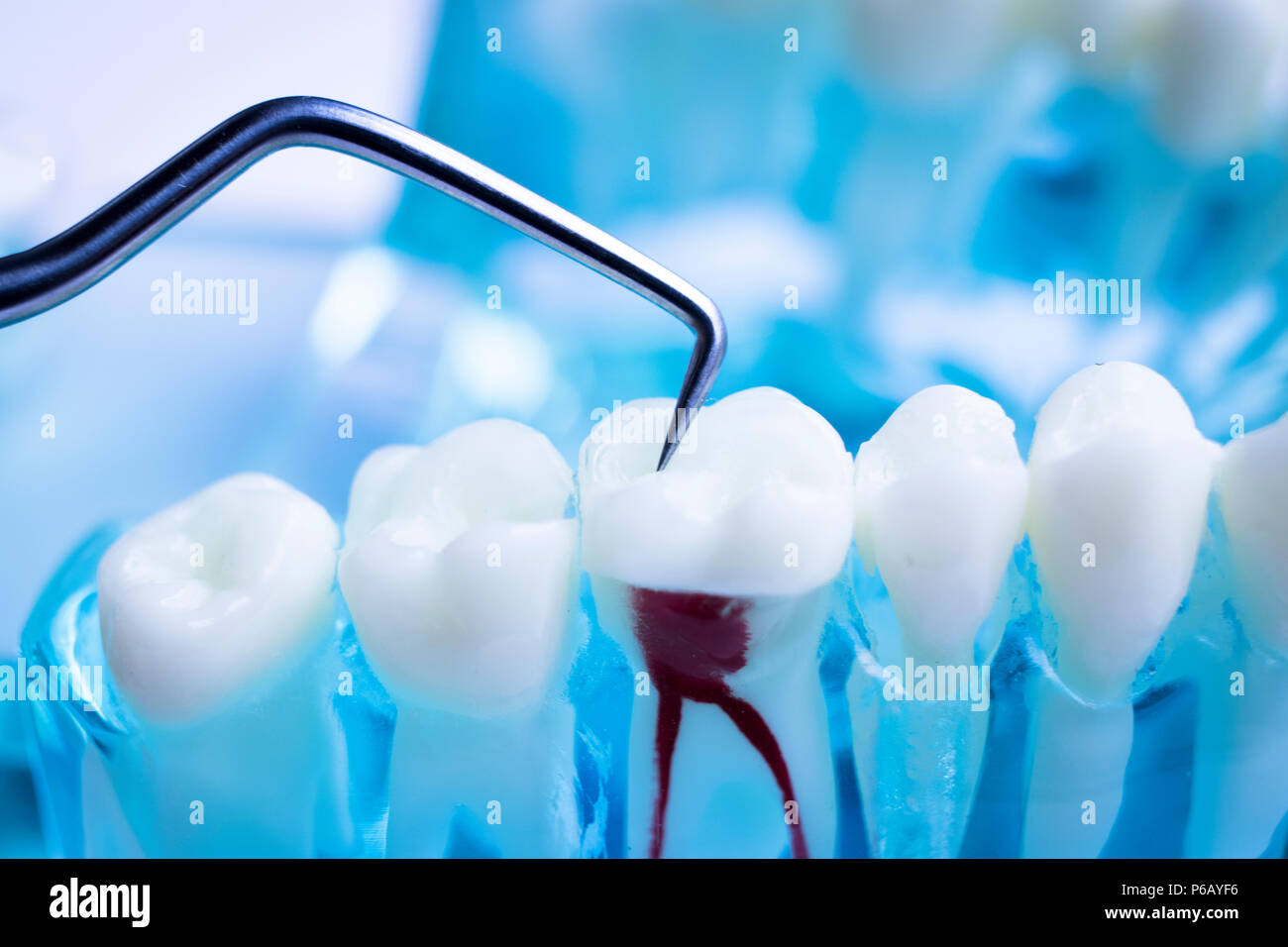 Dentist cleaning teeth with titanium metal tooth pick instrument to ...