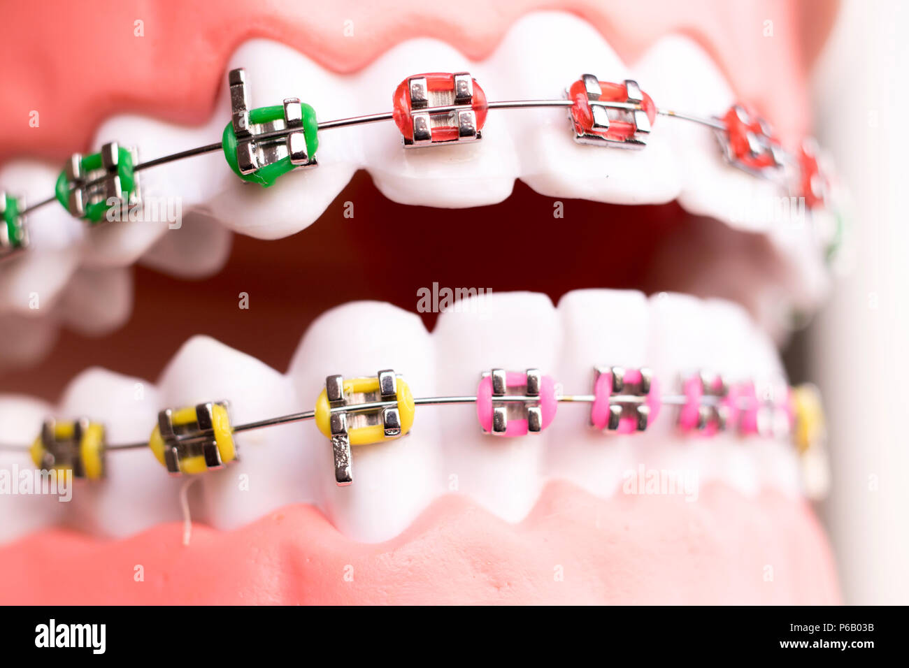 Dental metal braces teeth retainer aligners teaching orthodontics model ...