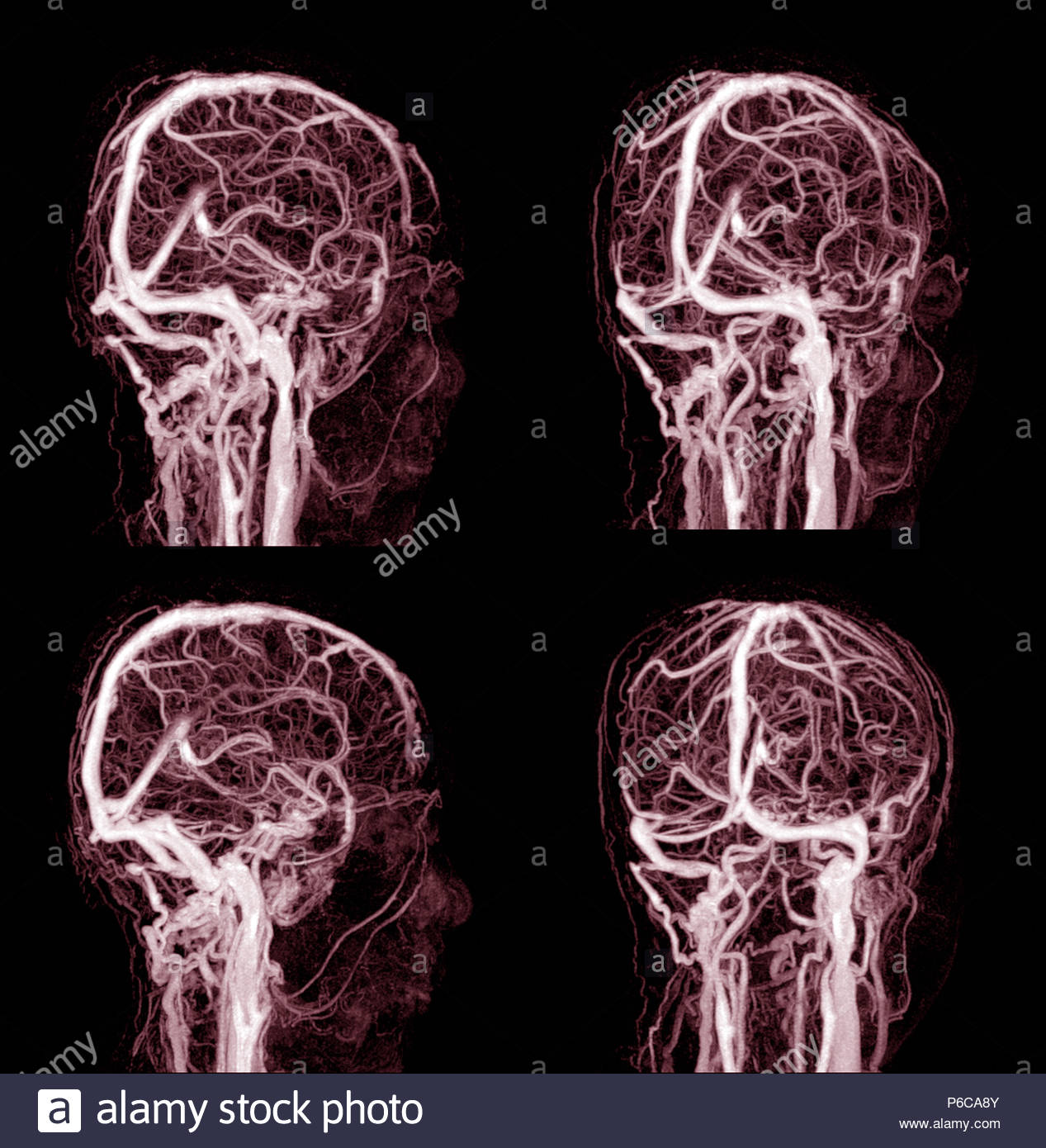 Ct Angiography Stock Photos & Ct Angiography Stock Images - Alamy