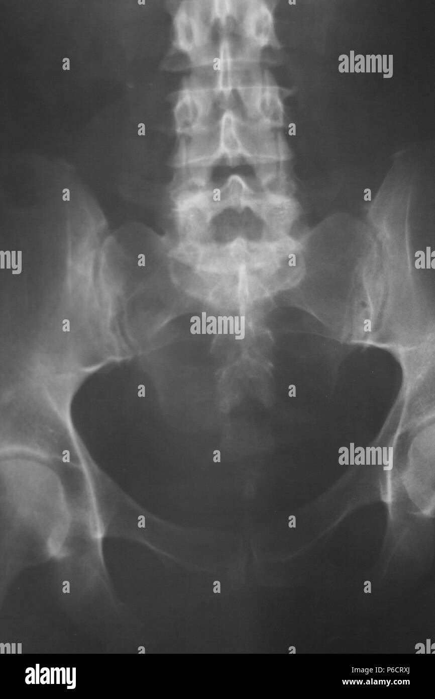 Medical hospital x-ray lowe back pain spine and hips traumatology scan ...