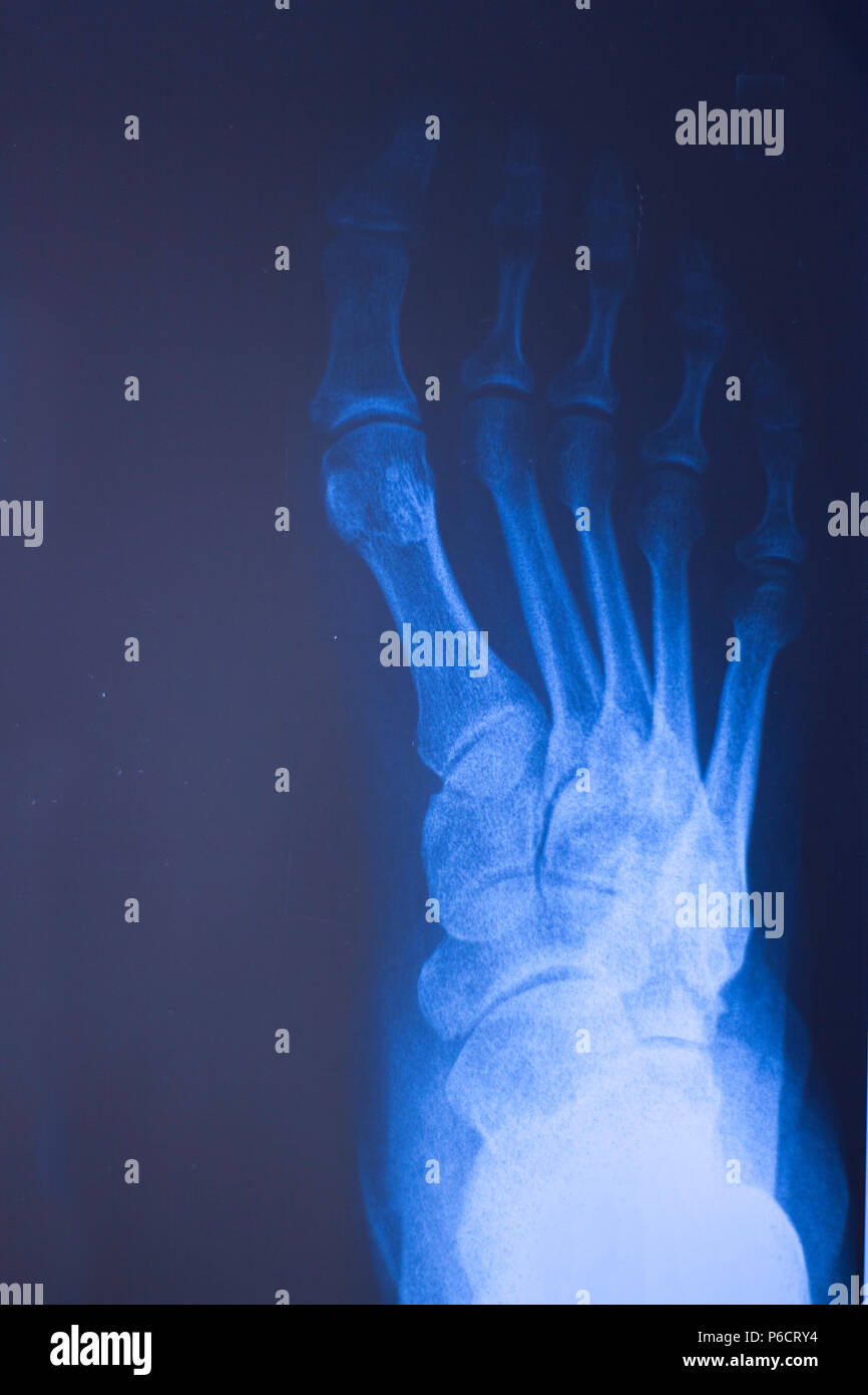 Medical hospital x-ray feet traumatology scan Stock Photo - Alamy