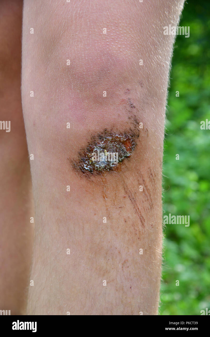 Boy wound on knee hi-res stock photography and images - Alamy