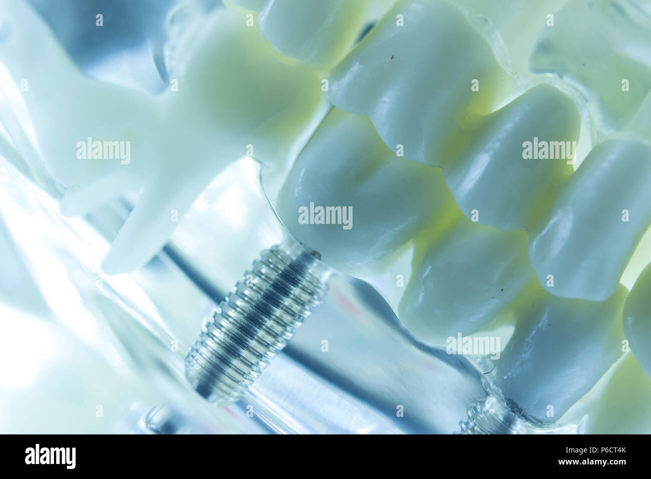 Dental titanium aesthetic orthodontic tooth implant in dentists mouth ...