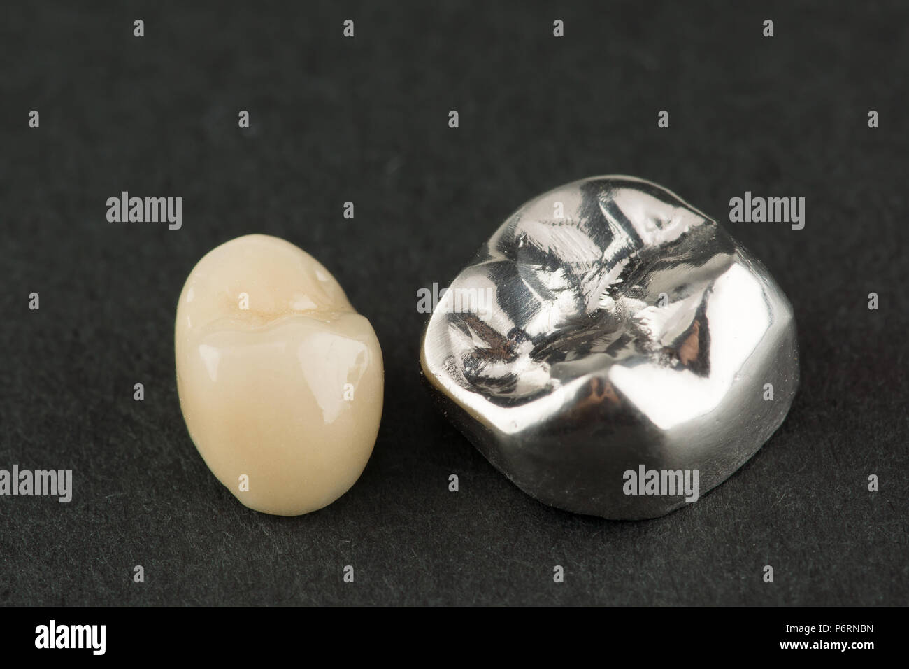 cast and cermet dental structures for restoration of teeth Stock Photo ...