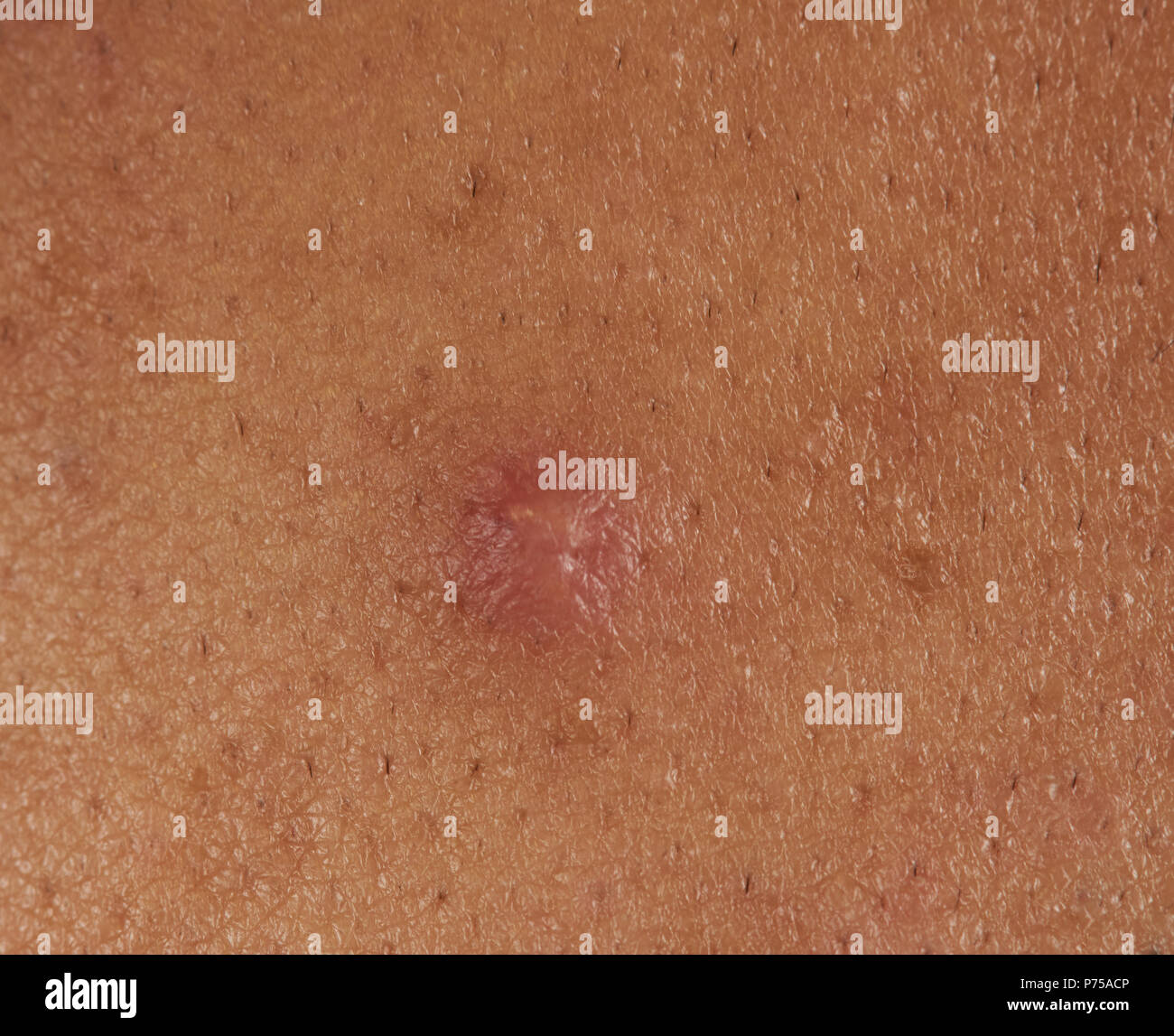 Pustule hi-res stock photography and images - Alamy