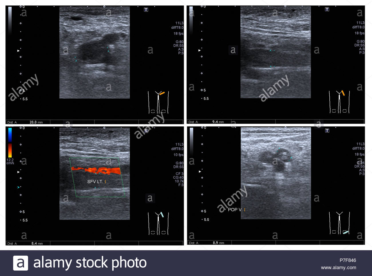 Popliteal Vein Stock Photos & Popliteal Vein Stock Images - Alamy