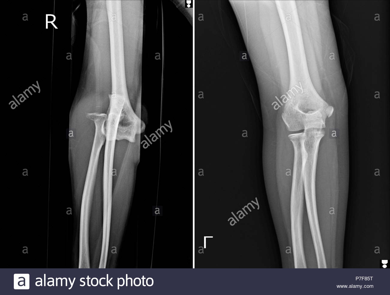 Humerus Fracture Stock Photos & Humerus Fracture Stock Images - Alamy
