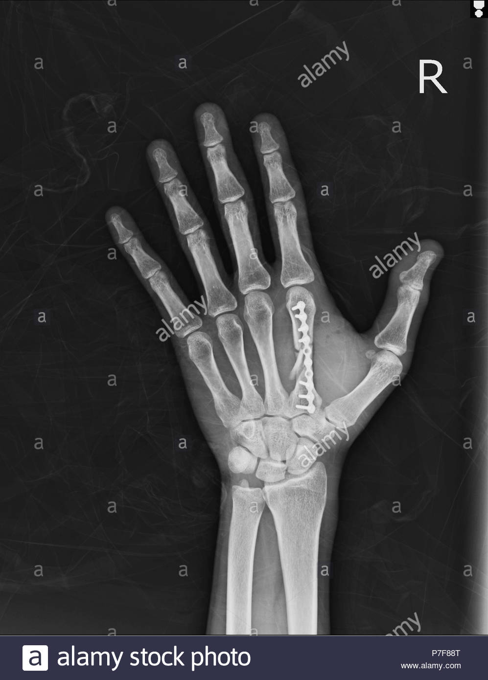 Metacarpal Fracture Stock Photos & Metacarpal Fracture Stock Images - Alamy