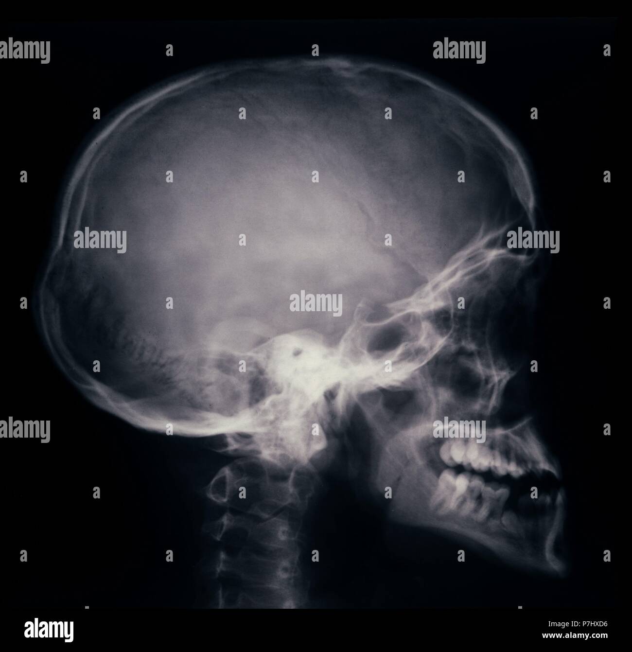 PANTALLA DE RAYOS X - FLUOROSCOPIA Stock Photo - Alamy