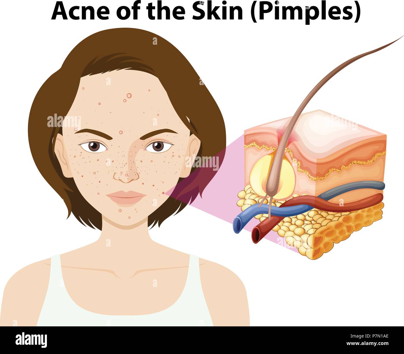 Acne of the skin on a woman illustration Stock Vector Image & Art - Alamy