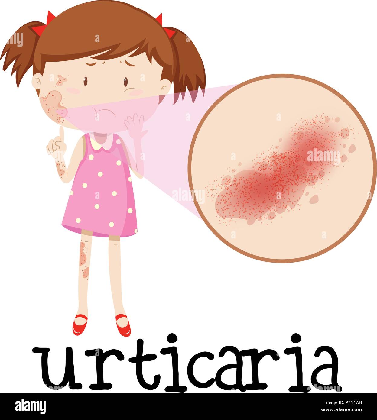 Urticaria Stock Vector Images - Alamy
