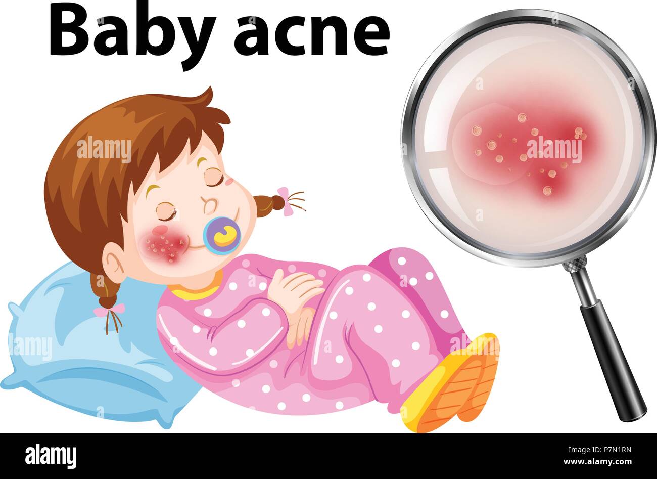 Acne drawing hi-res stock photography and images - Alamy