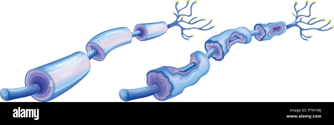 Human Nerves Cell and Peripheral Neuropathy illustration Stock Vector ...