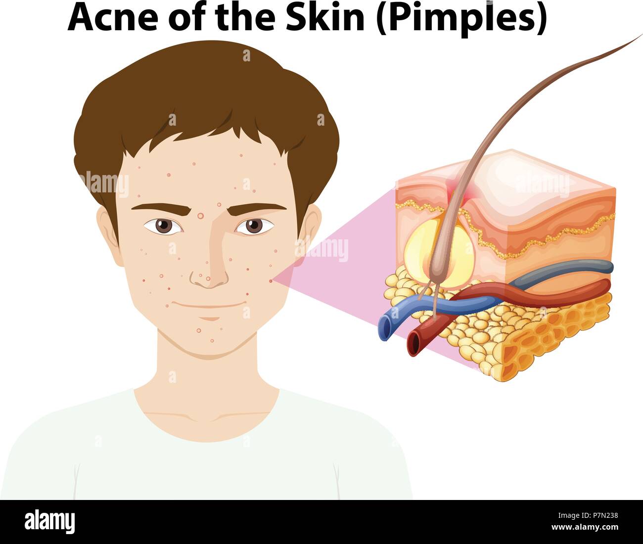 Pimple illustration hi-res stock photography and images - Alamy