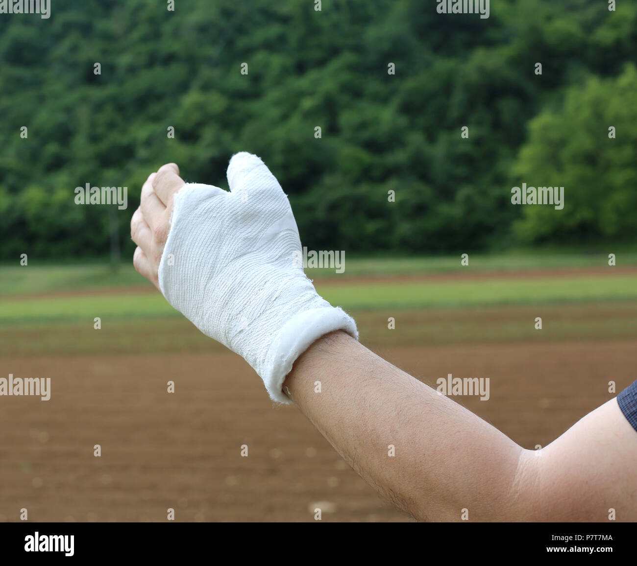 Plaster after wrist fracture hi-res stock photography and images - Alamy